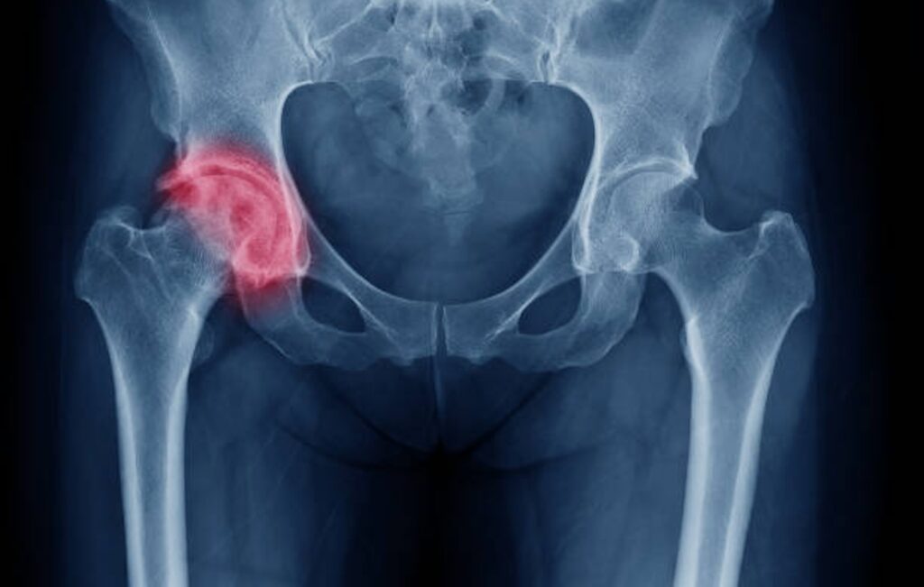 Let op! Deze symptomen wijzen op een versleten heup – Menszine